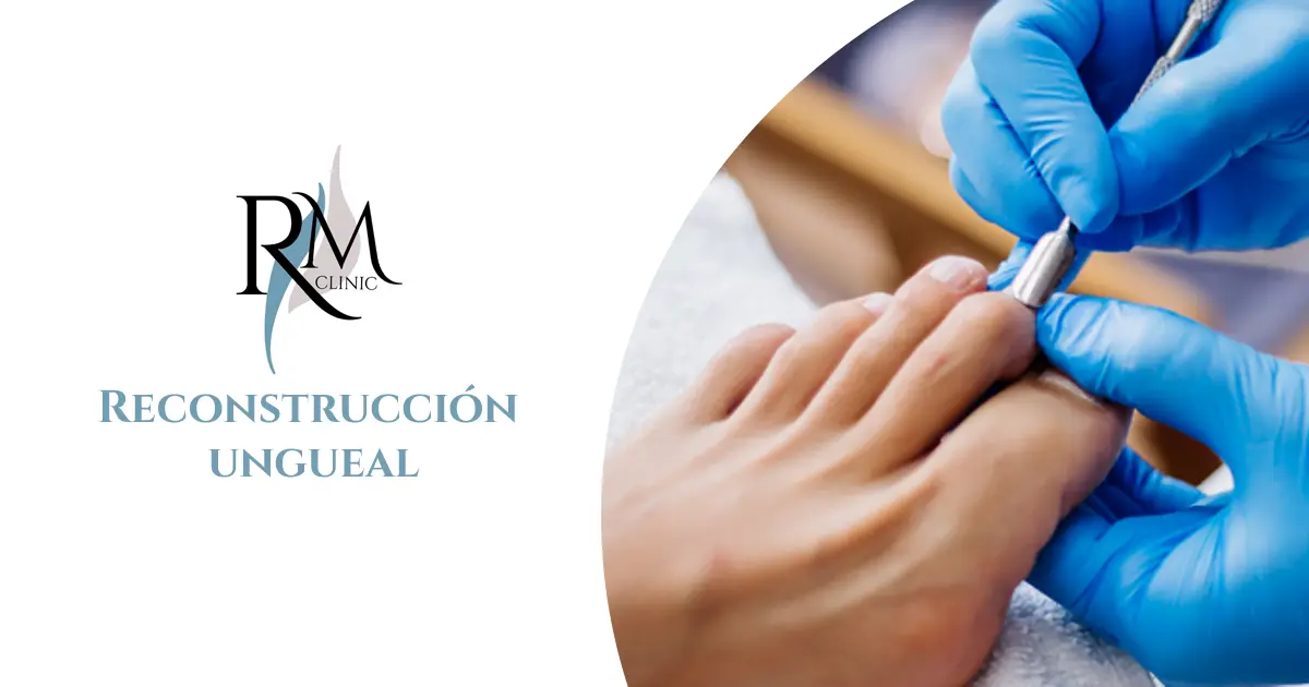Reconstrucción ungueal - RM CLINIC